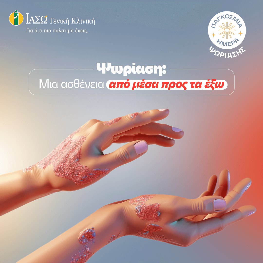 Ψωρίαση: Συμπτώματα, Αίτια και Θεραπεία