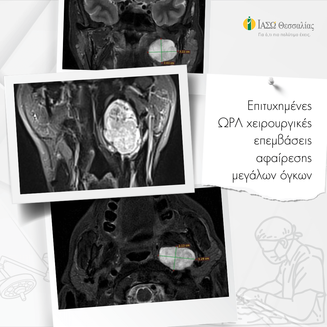 Απαιτητικές ΩΡΛ χειρουργικές επεμβάσεις αφαίρεσης μεγάλων όγκων στο ...